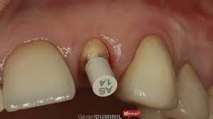 Empreinte optique : Inlay core avec tenon calibré – DENTISFUTURIS