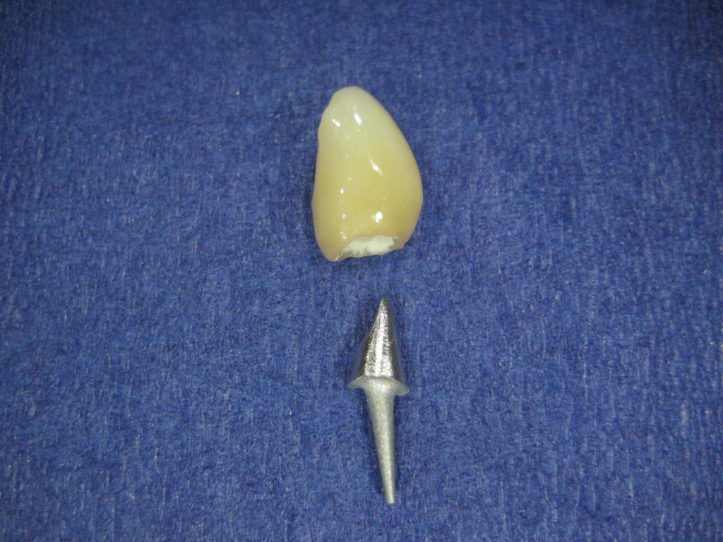 #MEDITi500 : premier cas d’Inlay-Core et Couronne en une seule étape ...