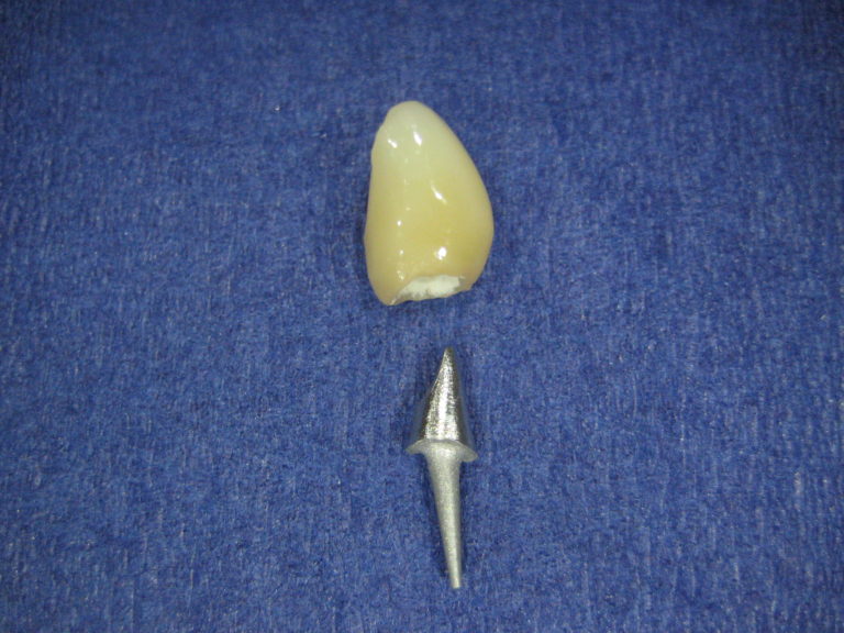 #MEDITi500 : premier cas d’Inlay-Core et Couronne en une seule étape ...