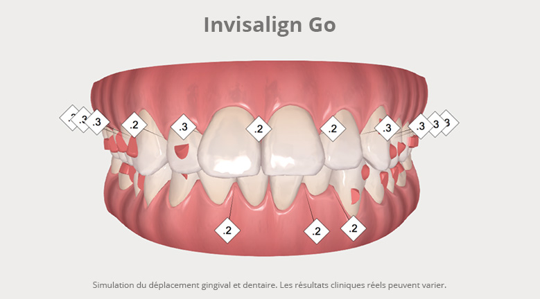 Cinq nouvelles fonctionnalités pour Invisalign Go – DENTISFUTURIS